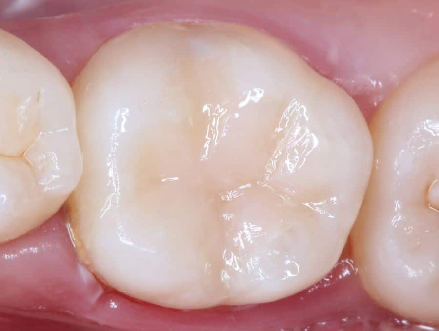 Dental Caries Treatment To Solve The Problems Generated