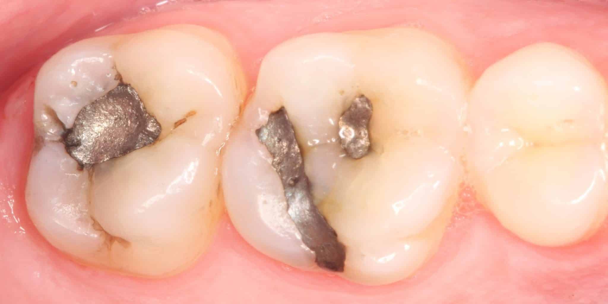 Eliminación amalgamas - Clínica Dental Padrós