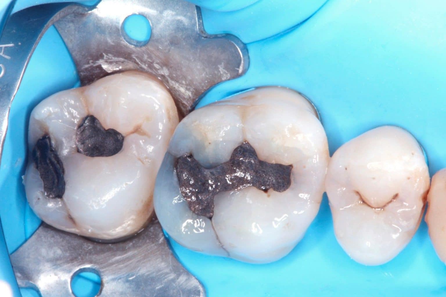 Amalgam removal - Clínica Dental Padrós